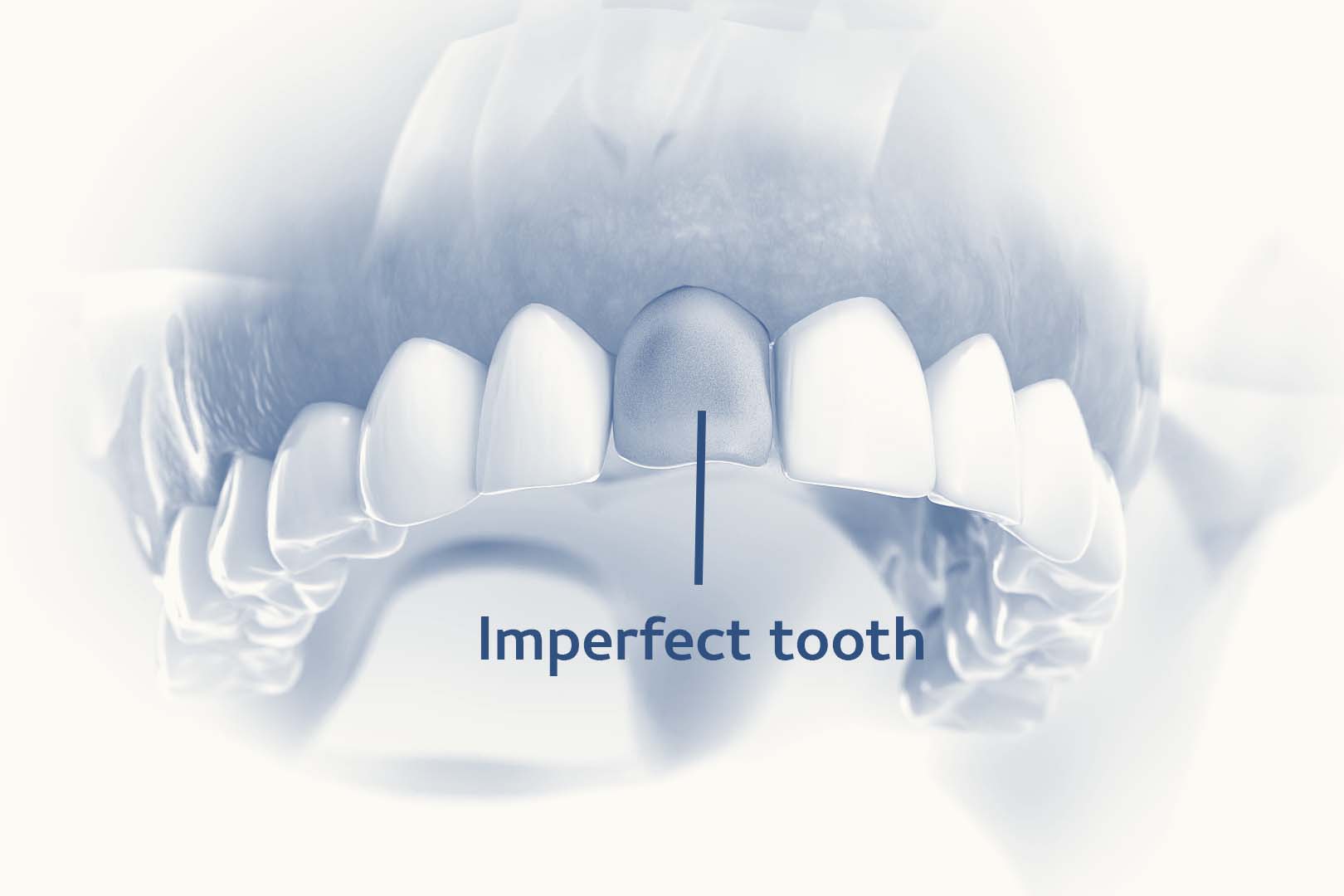 Dental Veneers in Singapore - Gentle Smile Dental Studio
